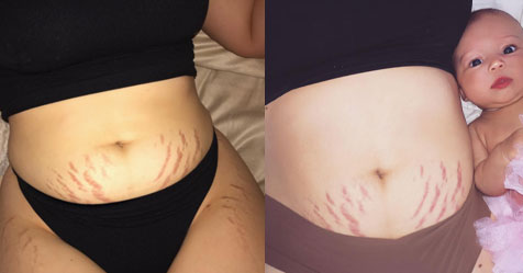3 Instagram mums who'll make you love your stretchmarks