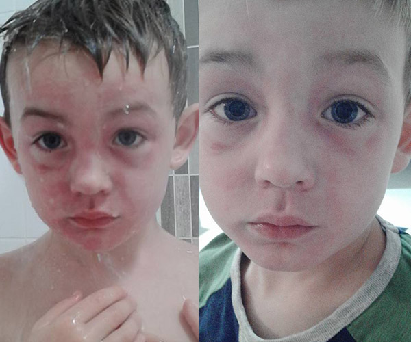 Child's face 'burnt' by Woolworths Halloween face paint