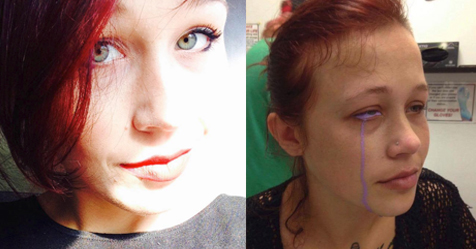 Woman with tattooed eye considering having eye removed