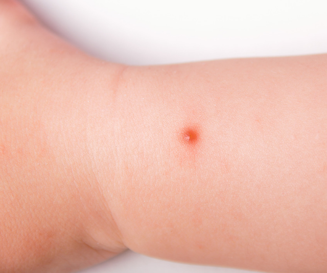 Natural remedies to fix your baby's skin woes